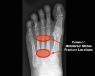 Metatarsal Stress Fractures Scott R Kilberg DPM