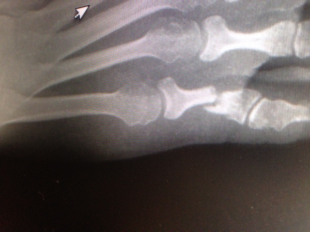 Toe Fractures – Scott R. Kilberg DPM