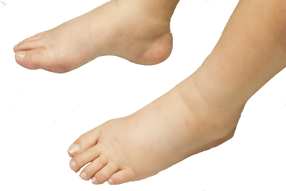 Foot Swelling and Warmth in Kids: Part 2 – Scott R. Kilberg DPM
